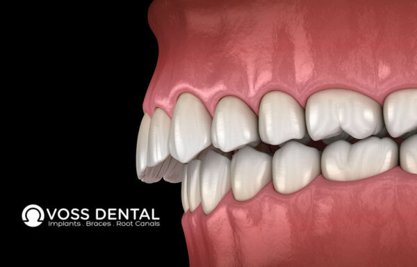 Fix Overbite Using Invisalign Voss Dental Oral Surgery Implant