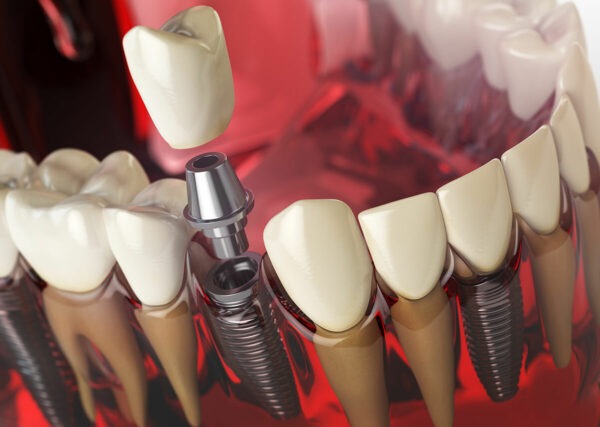 What you need to know about False Teeth in 2020 | Voss Dental - Oral ...