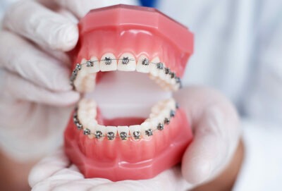 Bleeding gums with braces | Voss Dental - Oral Surgery | Implant