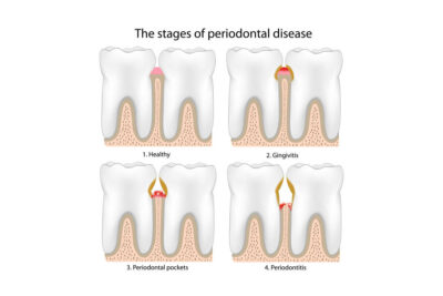 Periodontal disease - Periodontitis Symptoms & Treatment