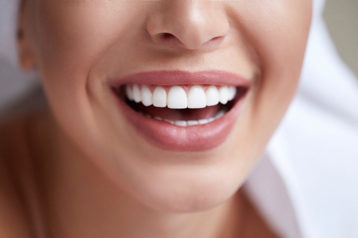Veneers | Voss Dental - Oral Surgery | Implant